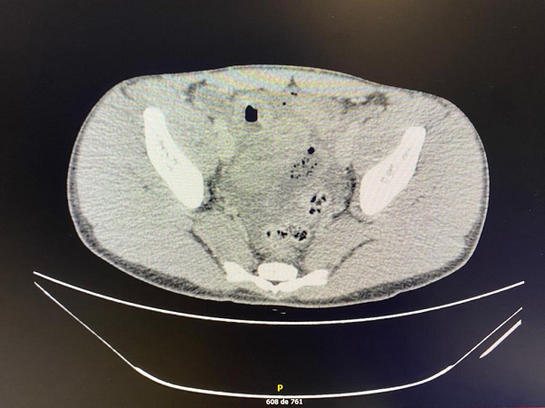 Continuum: Dolor abdominal de inicio brusco, no siempre es meteorismo