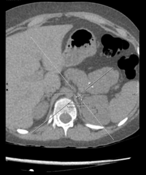 Continuum: Hipercortisolismo cíclico a estudio